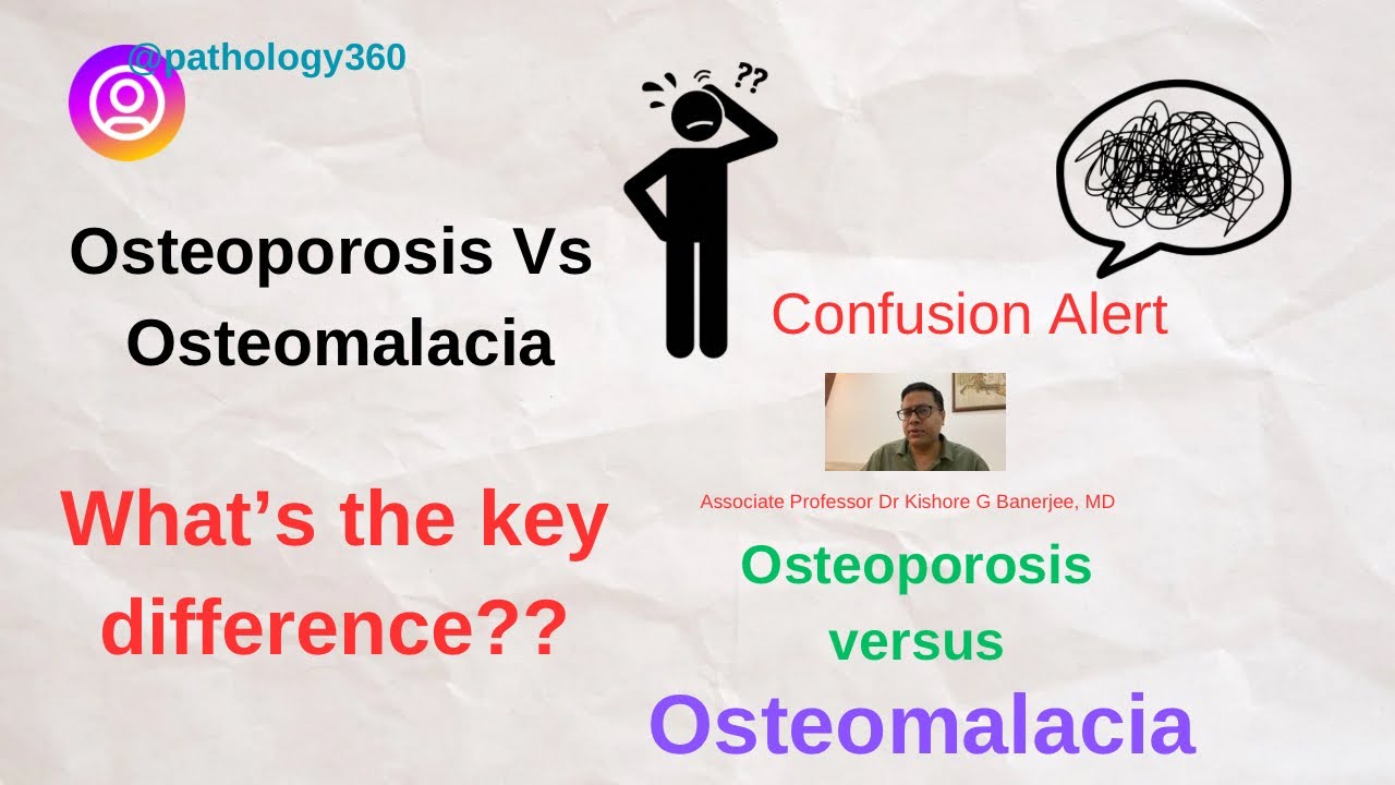 Osteomalacia Vs Osteoporosis Editing Overview Of Common Bone