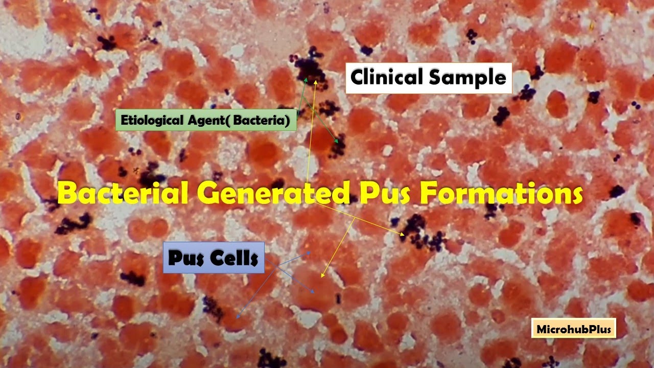 Pus causing Bacteria in Gram Stain Microscopy at various magnifications ...