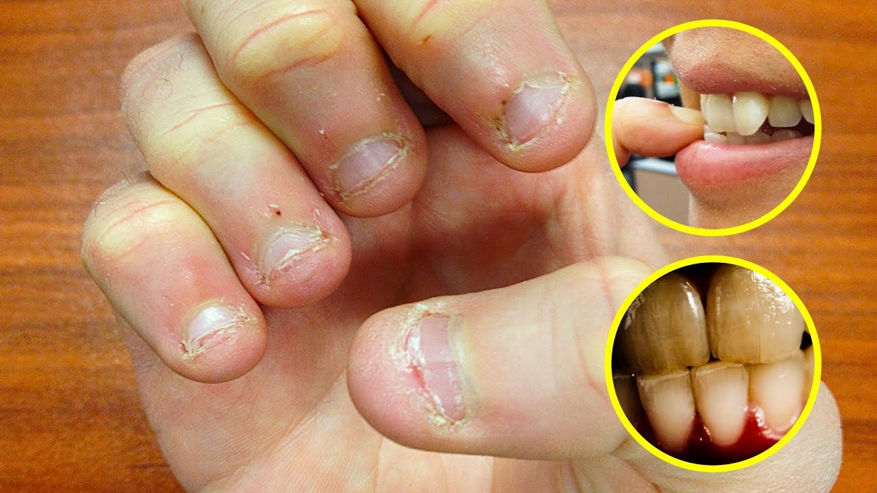The Habit Of Biting Nails Is Destroying Your Health Here s How YouTube