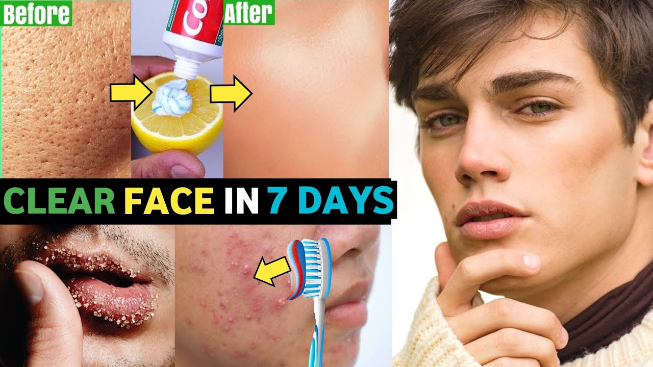 5 COMMON Skin Problems, 5 Easy Solutions For HANDSOME Face | Acne, Dark ...