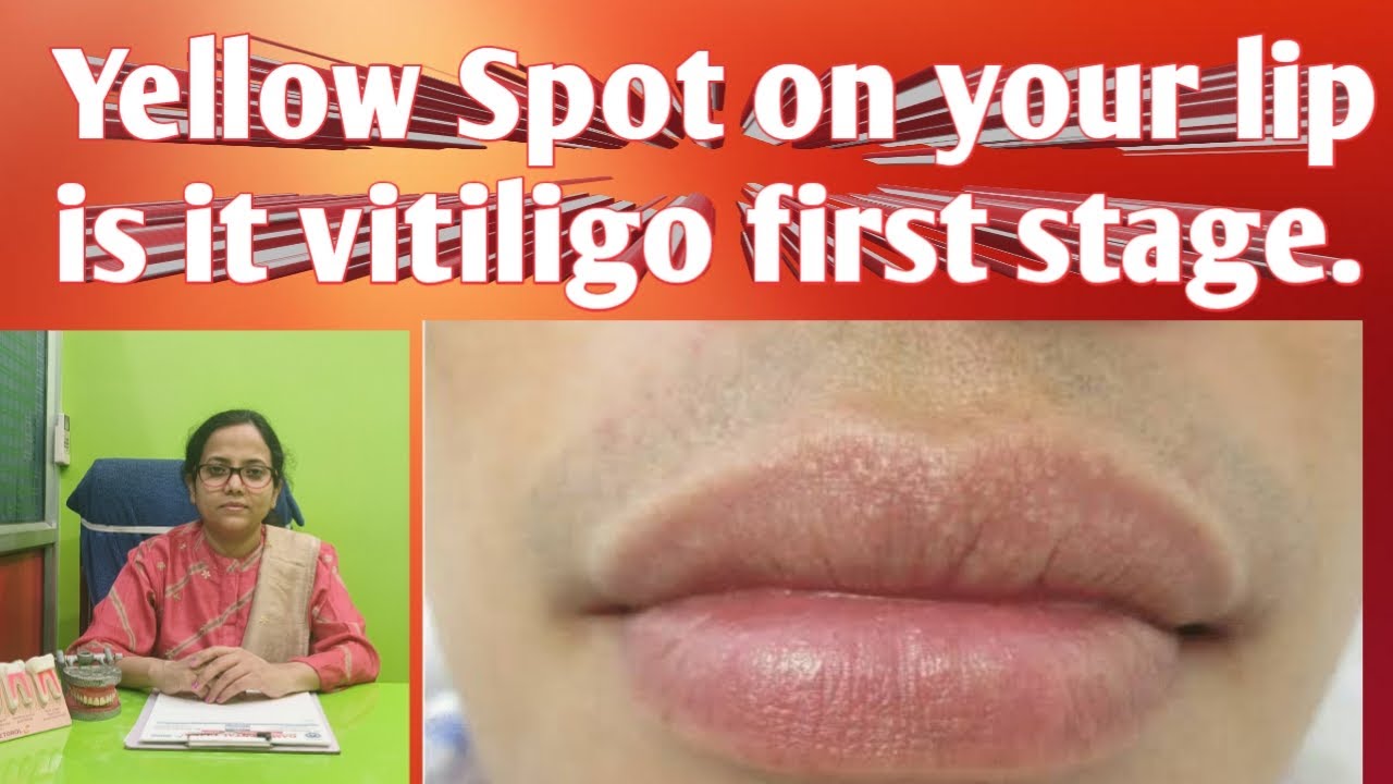 Vitiligo On Lips: How To Treat White Patches On Lips – BYAMJ