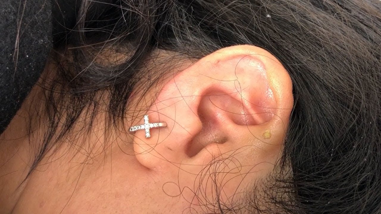 Bit Ear Pimple with Dr. Gilmore - YouTube