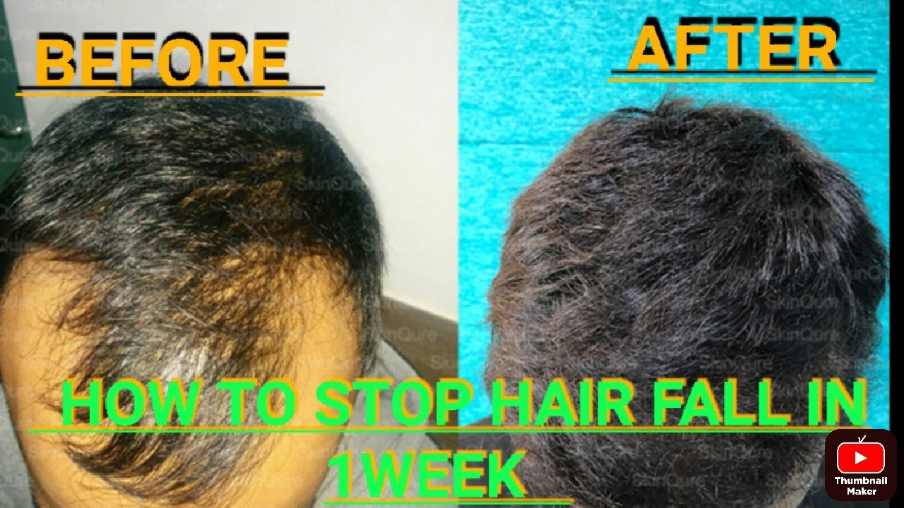 HOW I STOPPED MY HAIR FALL | how to stop hair fall for men - YouTube