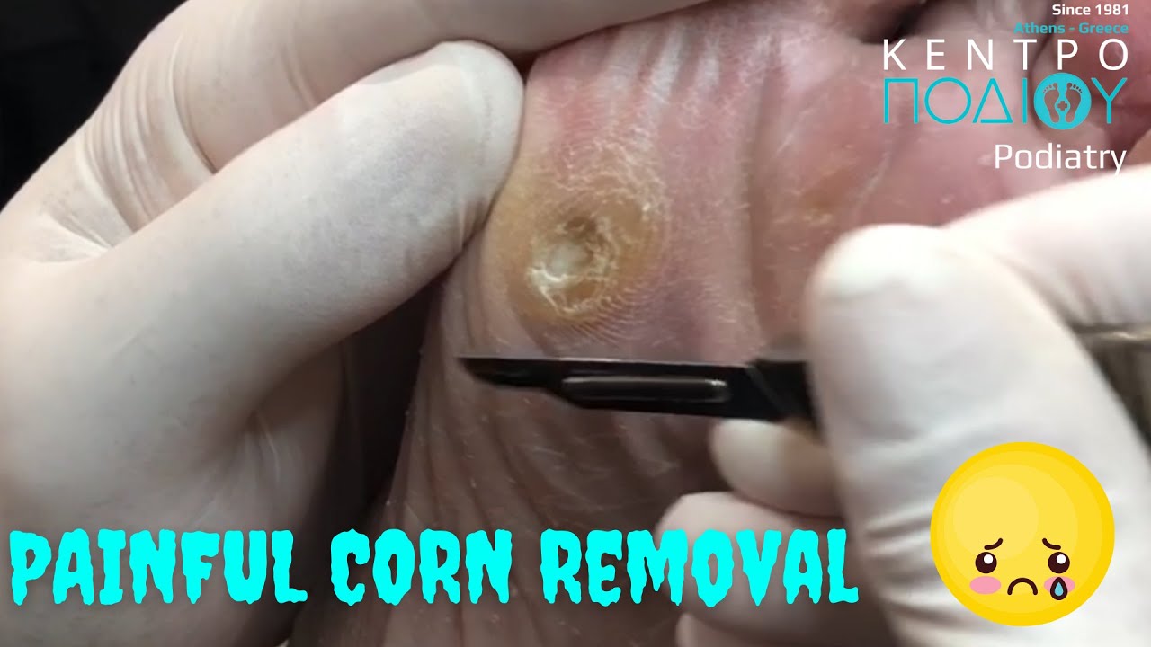 Metatarsal corn removal|Αφαίρεση τύλου|Κέντρο Ποδιού Podiatry ...