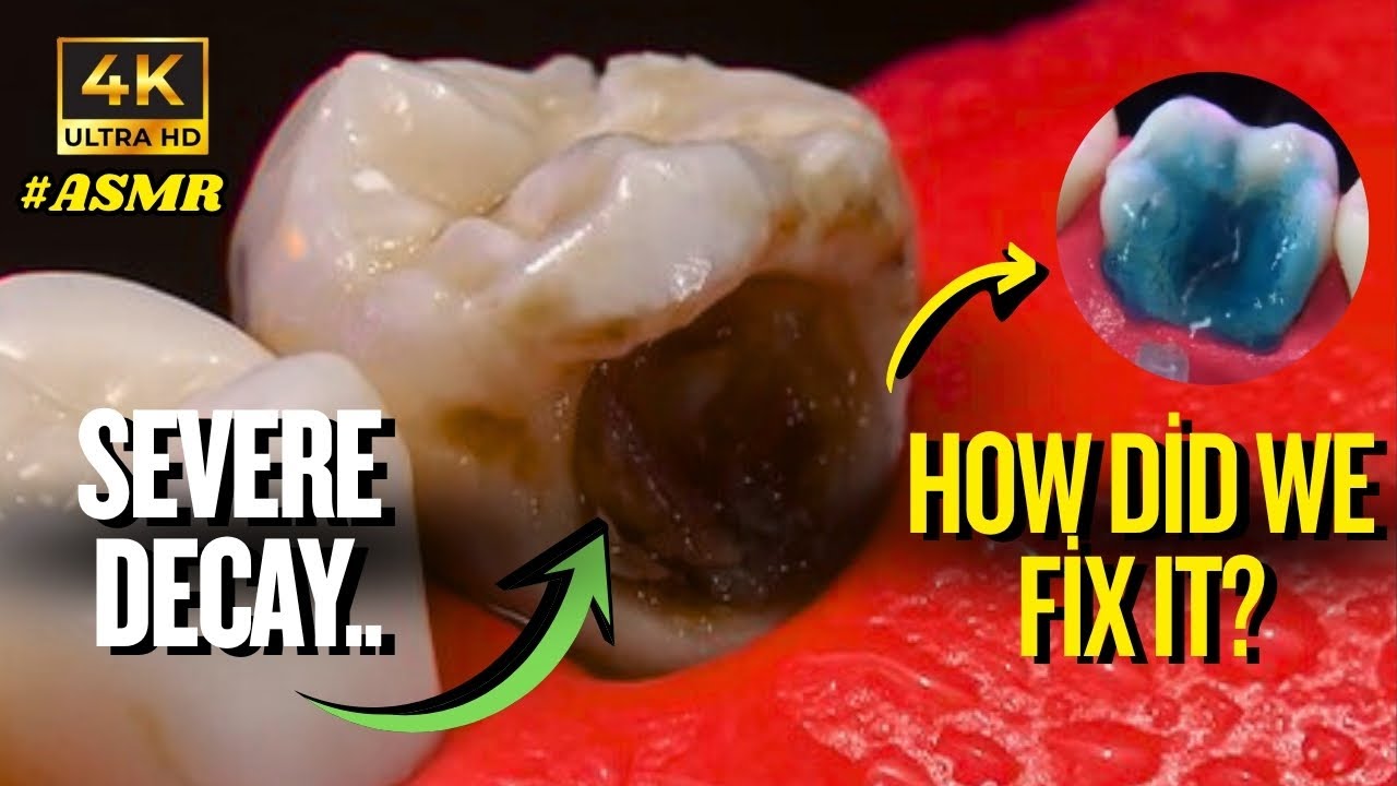 How to Save a Tooth with Deep Decay? 4K Root Canal Treatment and Onlay ...