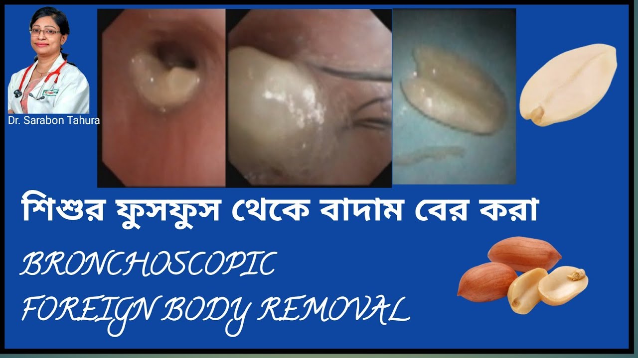 শিশুর ফুসফুস থেকে বাদাম বের করা ঢাকা স্কয়ার হাসপাতালে Dr. Sarabon ...