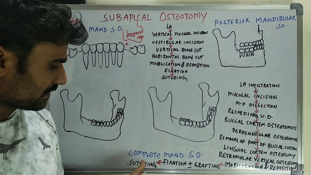 Subapical osteotomy - YouTube