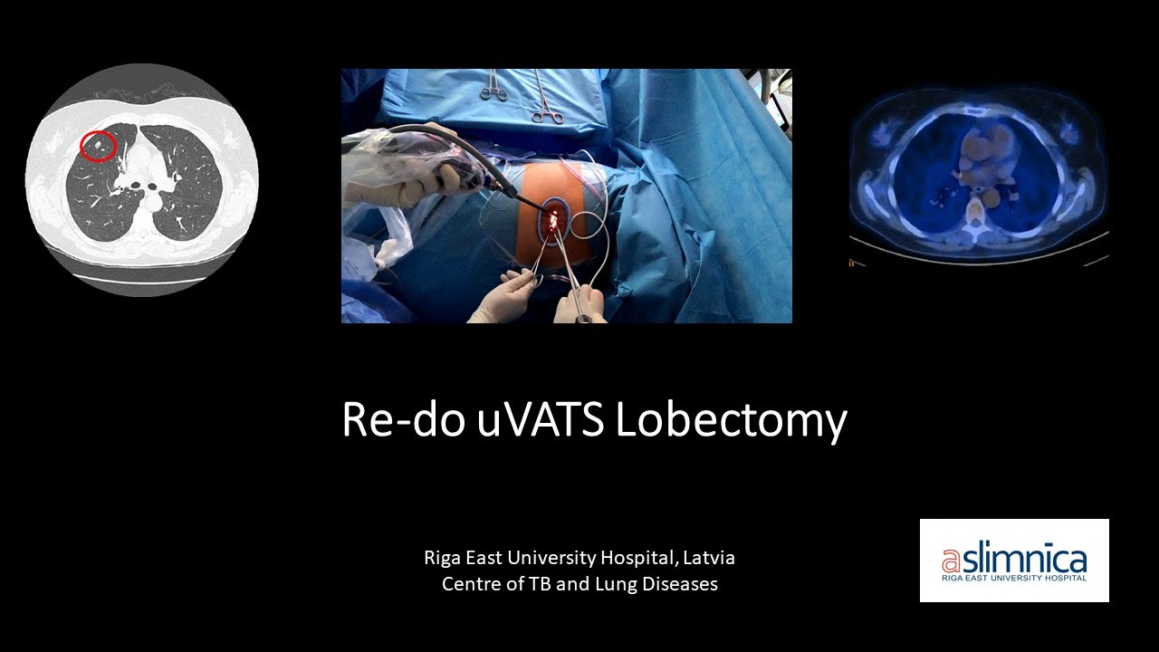 Re-do uVATS Lobectomy (narrated) - YouTube
