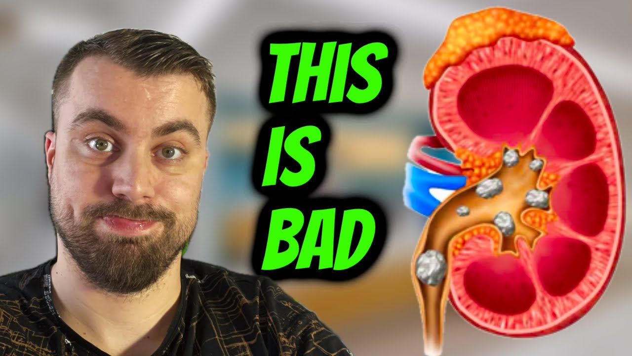 Kidney Stones Experience - My first 5.4mm stone - YouTube