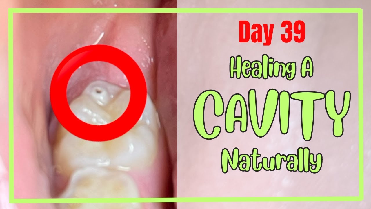 Healing a Cavity Naturally - Our Journey Day 39 - YouTube
