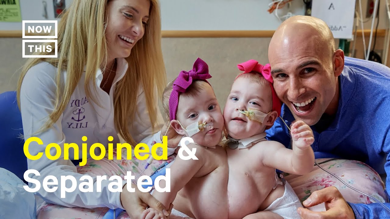 Conjoined Twins Separated After Successful Surgery - YouTube
