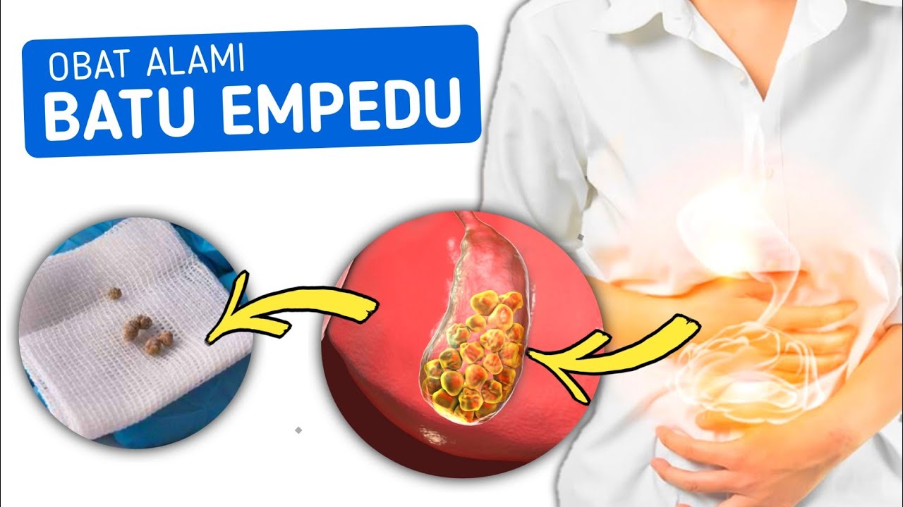 Nyeri Batu Empedu? Ini Dia Tanaman Obat Penghancur Batu Empedu - YouTube