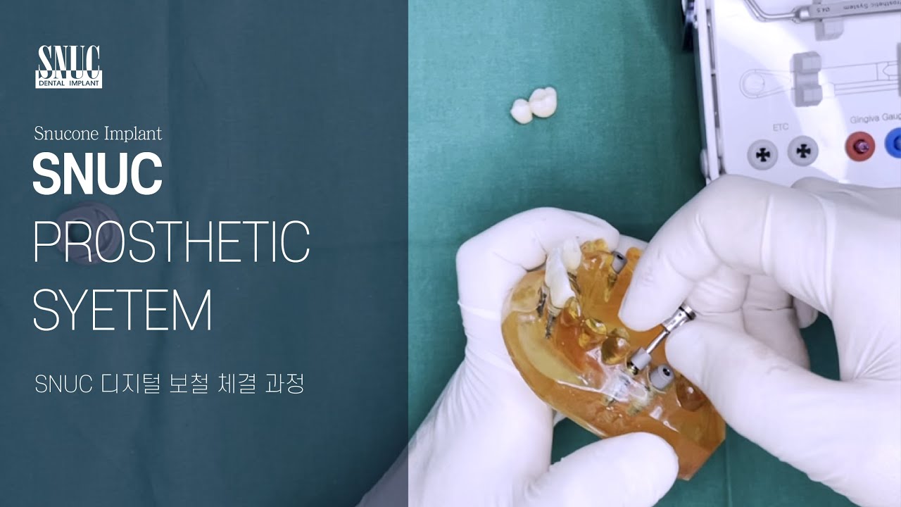 [Snucone Implant] SNUC Prosthetic System SNUC디지털 보철 체결영상 - YouTube