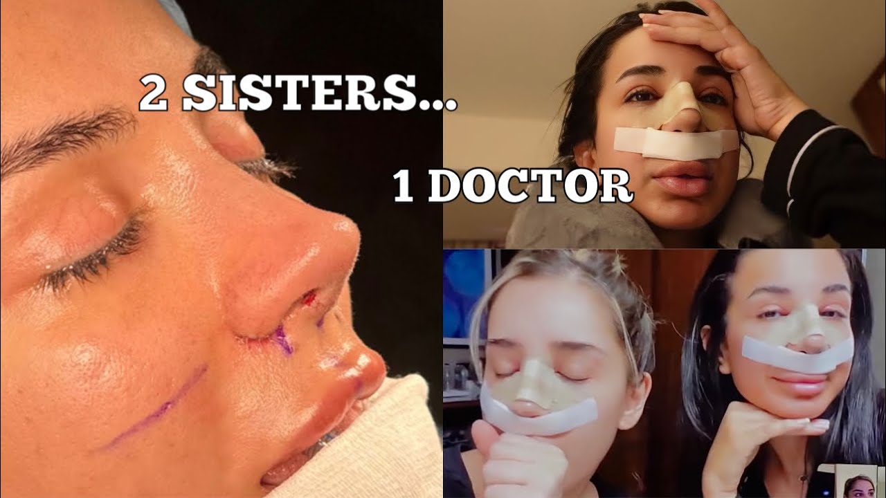I GOT A NOSE JOB...AGAIN!! | rhinoplasty in Turkey PART 1 - (Dr Emrah ...