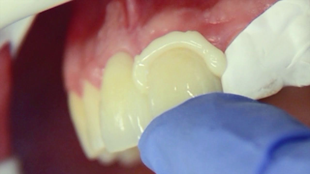 RelyX Universal Easy excess clean up - YouTube