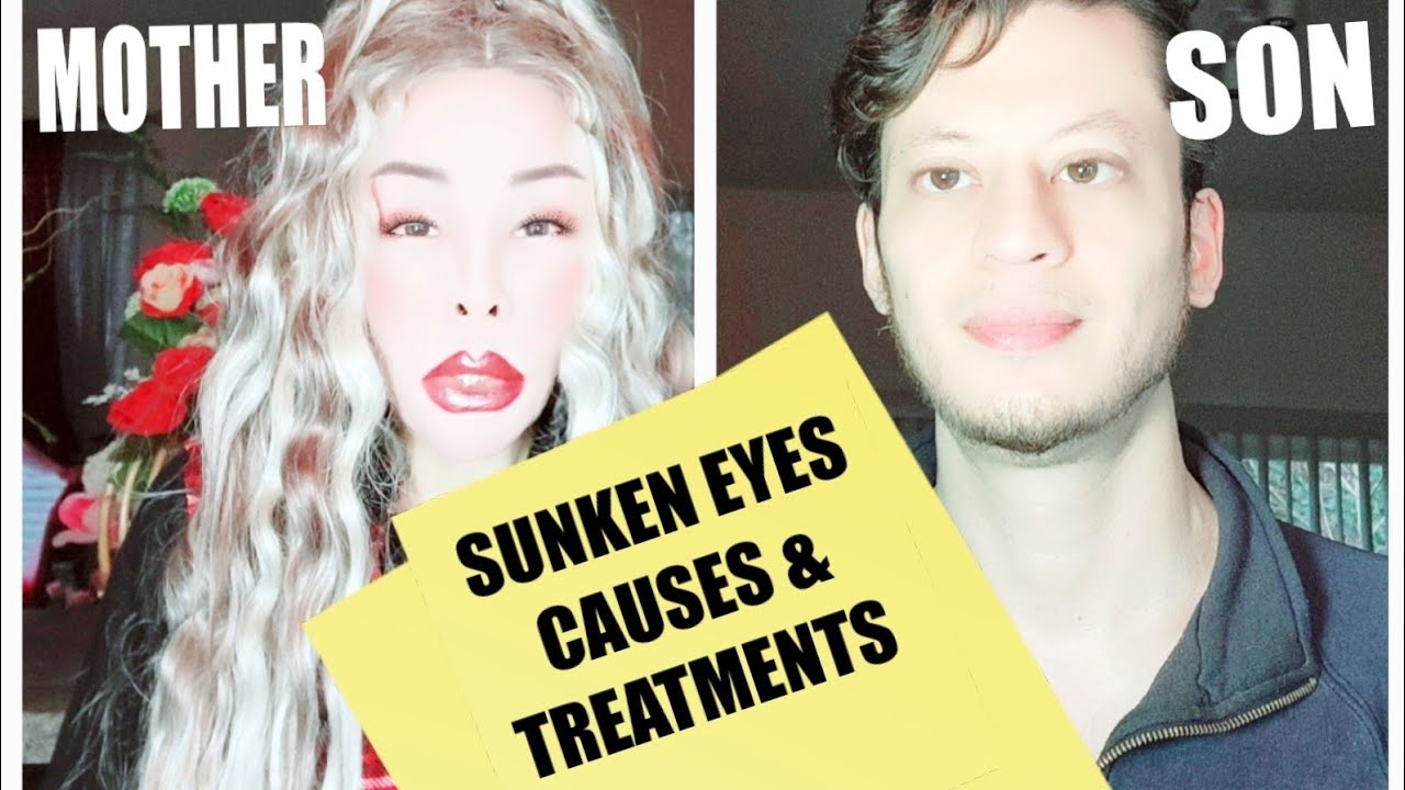 Are you dealing with SUNKEN-DEFLATED Eyes? Causes and Treatments - YouTube