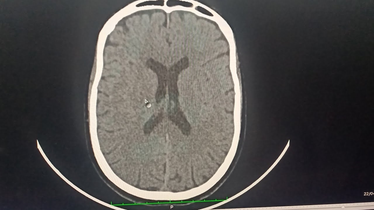 How To Read CT Scan Head - YouTube