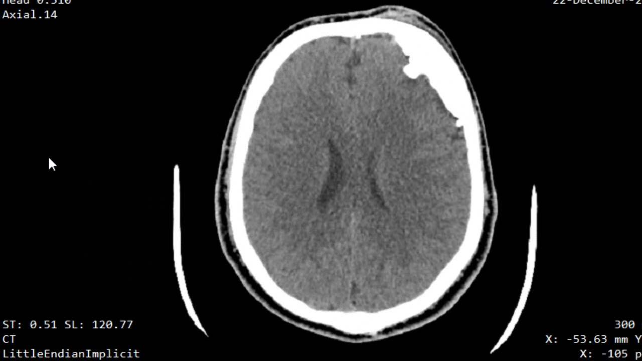 CASE 955 CT BRAIN Hyperostosis Frontalis Interna - YouTube