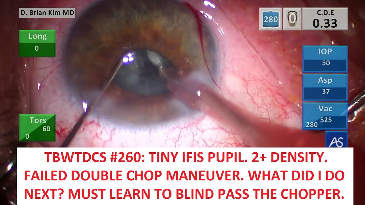 TBWTDCS #260: Tiny IFIS Pupil. Failed Double Chop Maneuver. Now What ...