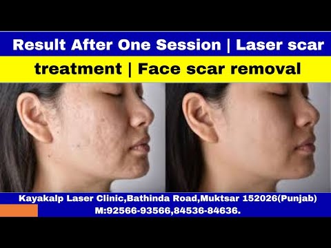 Result After One Session | Laser scar treatment | Face scar removal ...