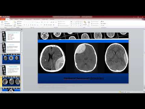 Acil Serviste Bilgisayarlı Beyin Tomografisi Yorumlama