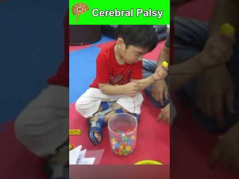 Cerebral Palsy Diagnosis to Dual Hand Dexterity in 1 Year with Cellular Therapy