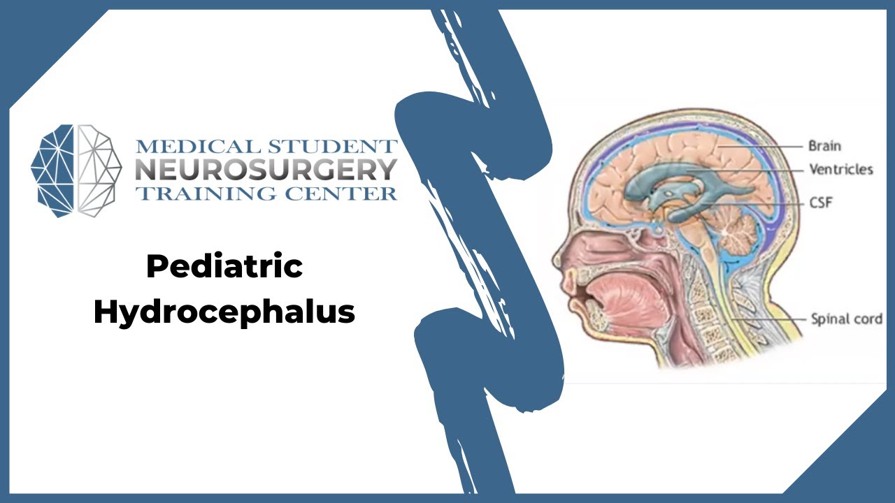 Pediatric Hydrocephalus - YouTube