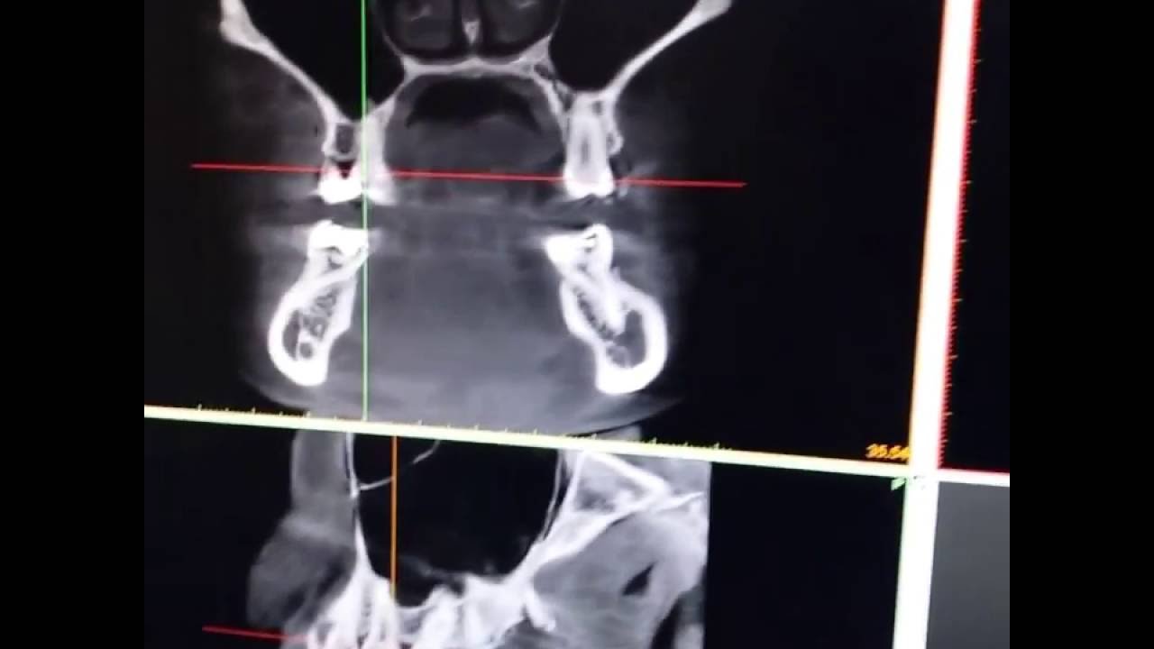 CBCT available now at Icon Dental! - YouTube