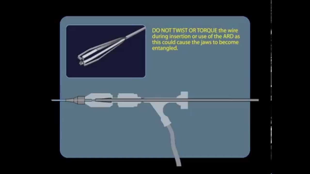 Alligator Retrieval Device - YouTube