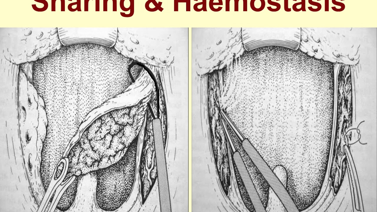 4 Tonsillectomy & adenoidectomy || for MBBS, PG students - YouTube