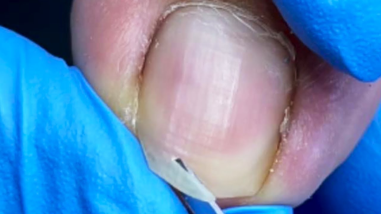 So Cool! Trimming Extremely Long Toenails That Are Badly Ingrown - YouTube
