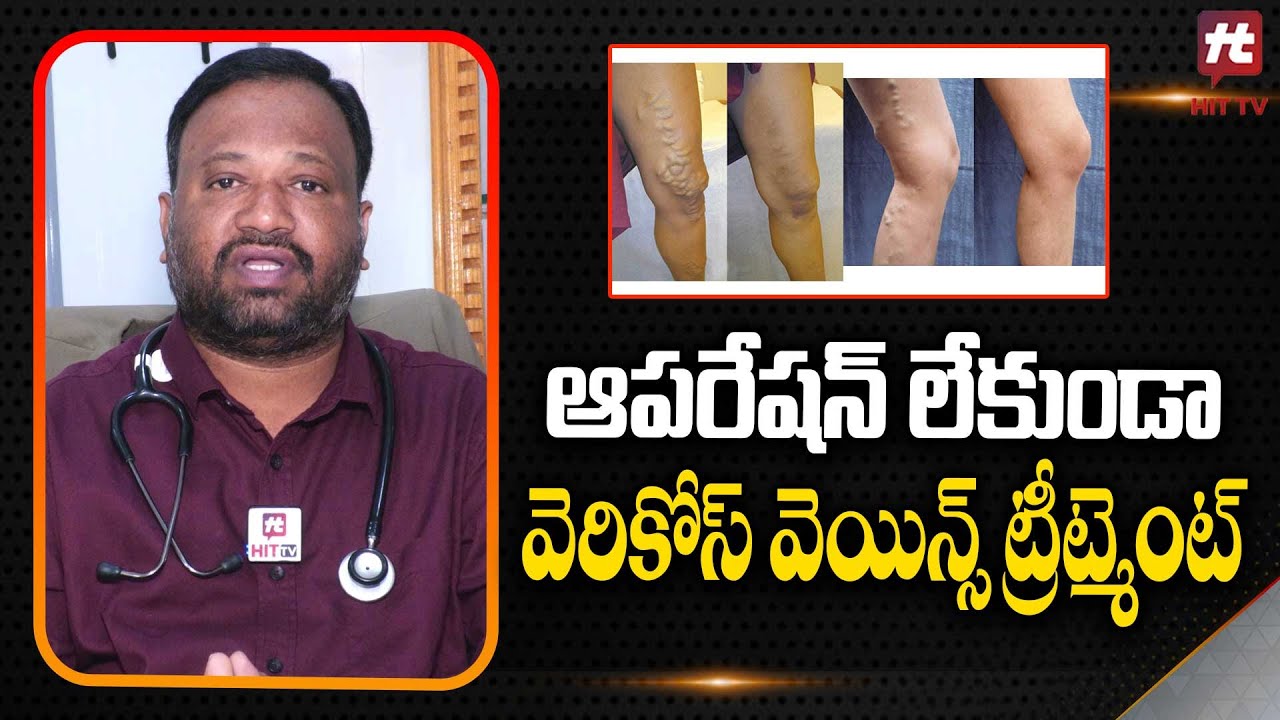 ఆపరేషన్ లేకుండా వెరికోస్ వెయిన్స్ ట్రీట్మెంట్ | Dr M Ravi Kumar ...