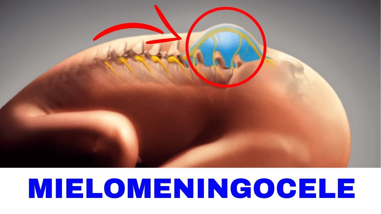 Mielomeningocele | Qué es y sus caracteristicas. - YouTube