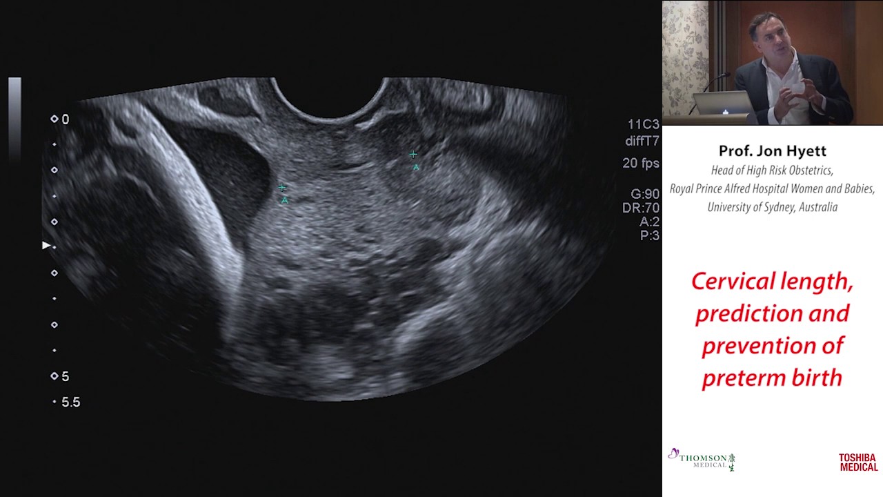 2 Cervical length prediction and prevention of preterm birth - YouTube