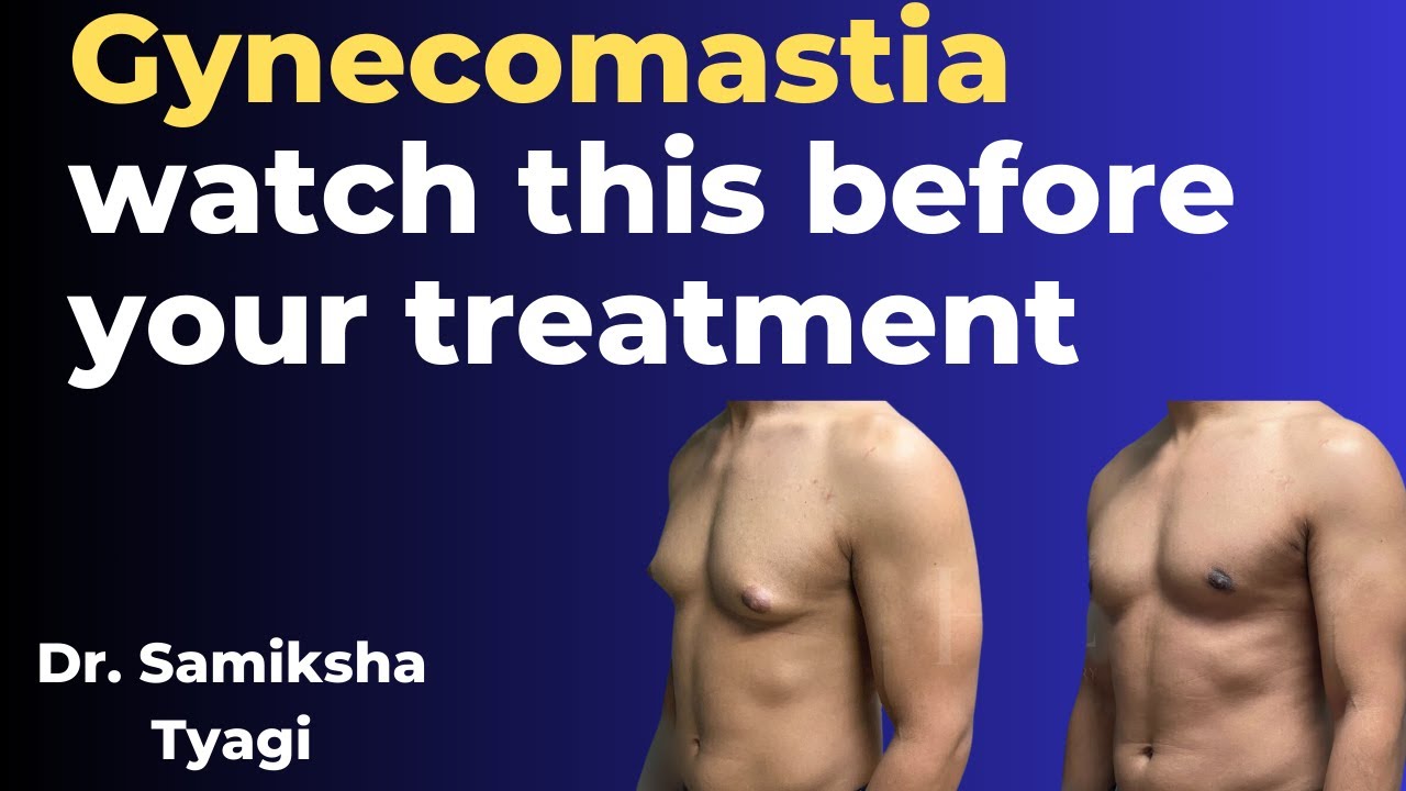 Gynecomastia - watch this before your treatment | Dr. Samiksha Tyagi ...
