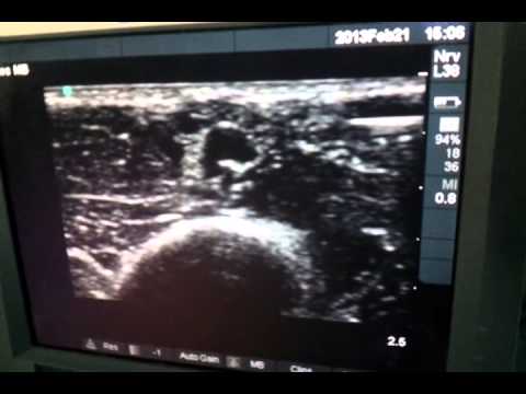 usg guided axillary block - YouTube