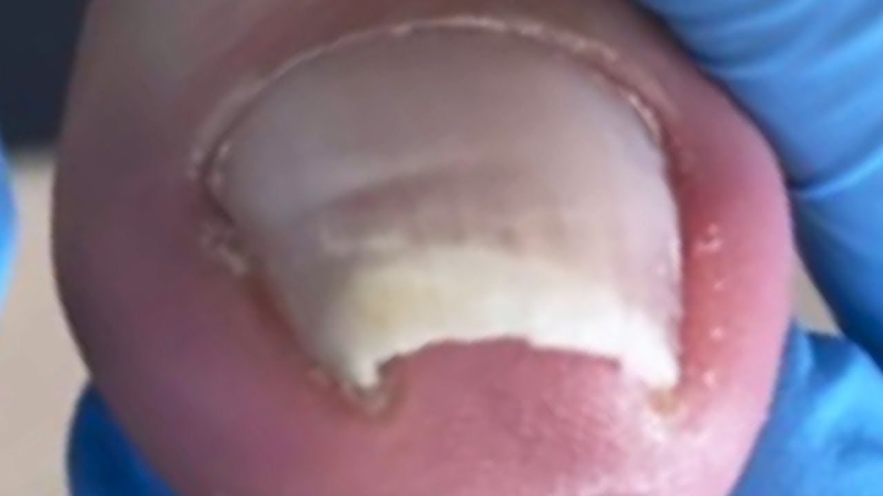 Trim Super Long Toenails, The Process Is Very Decompressive - YouTube