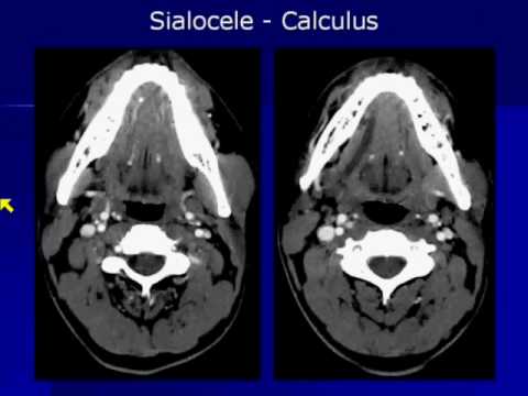 Neuroradiology Head and Neck Imaging Teaching Case 1.wmv - YouTube
