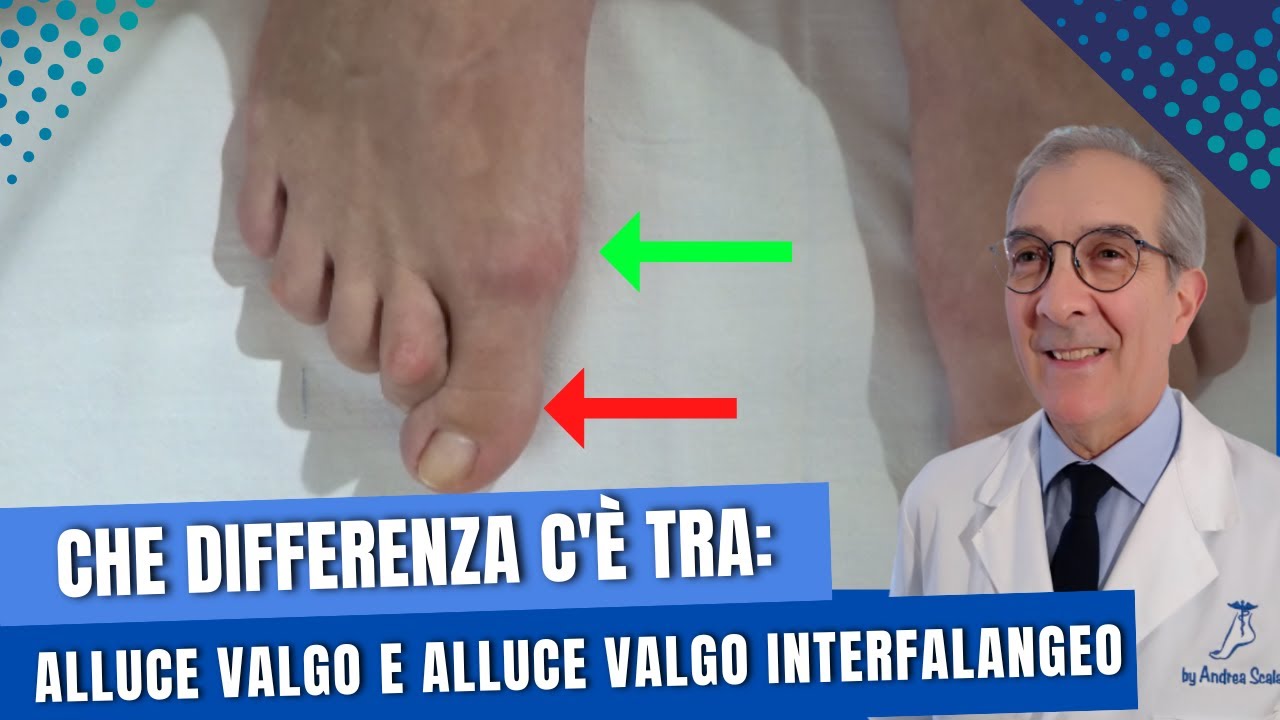 Alluce valgo interfalangeo : cos'è, sintomi, cura | Dott. Andrea scala ...