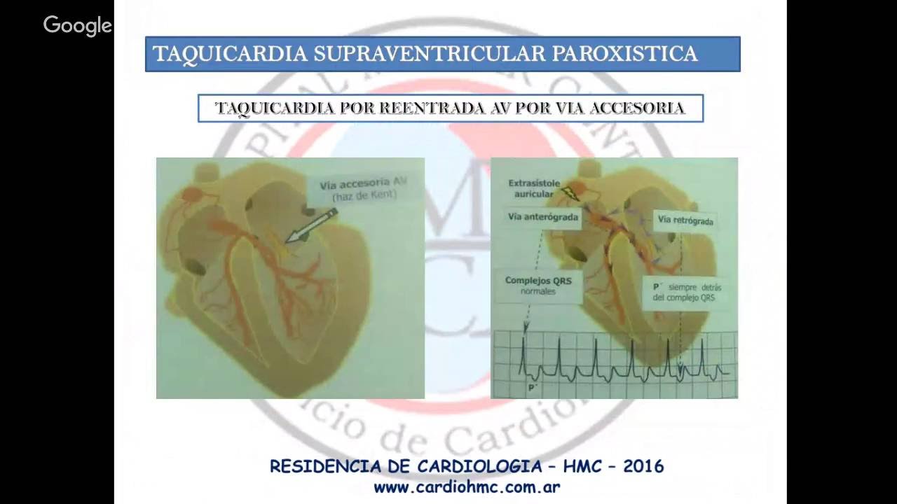 Taquicardia de QRS angosto regular - YouTube