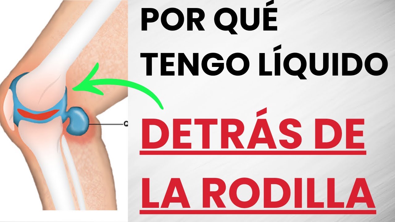 🦵 Por Qué Tenemos LÍQUIDO e INFLAMACIÓN Detrás De LA RODILLA y Cómo ...