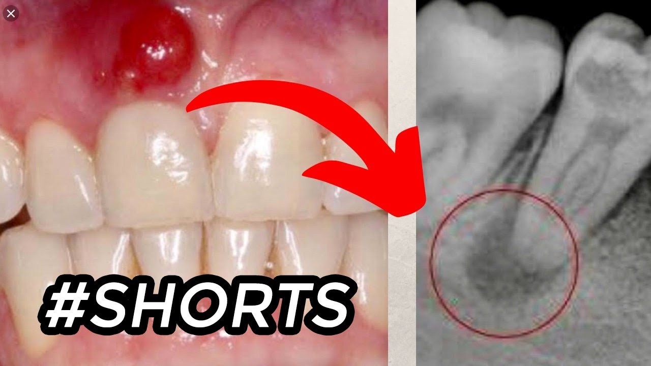 PORQUE salen ABSCESOS en las ENCÍAS / ABSCESO DENTAL por CARIES #shorts ...