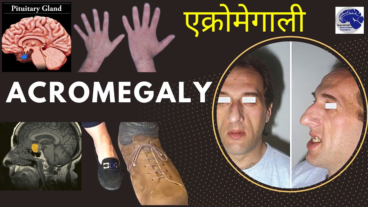 Acromegaly.Successful brain tumor surgery. Dr Jaydev Panchwagh - YouTube