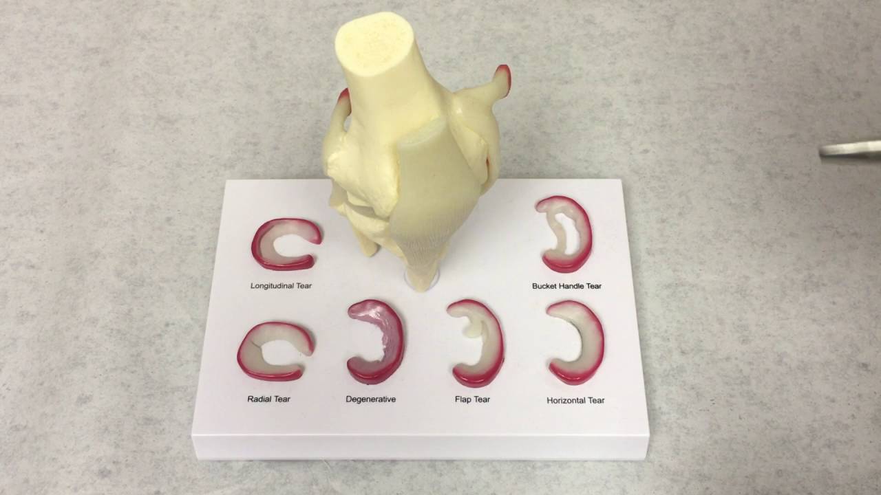 Repair of Radial Meniscus Tear - YouTube