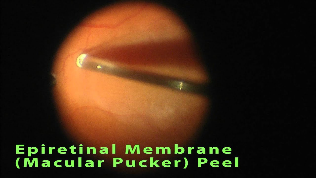 Vitrectomy for Macular Pucker - 25 Gauge - High Definition - YouTube