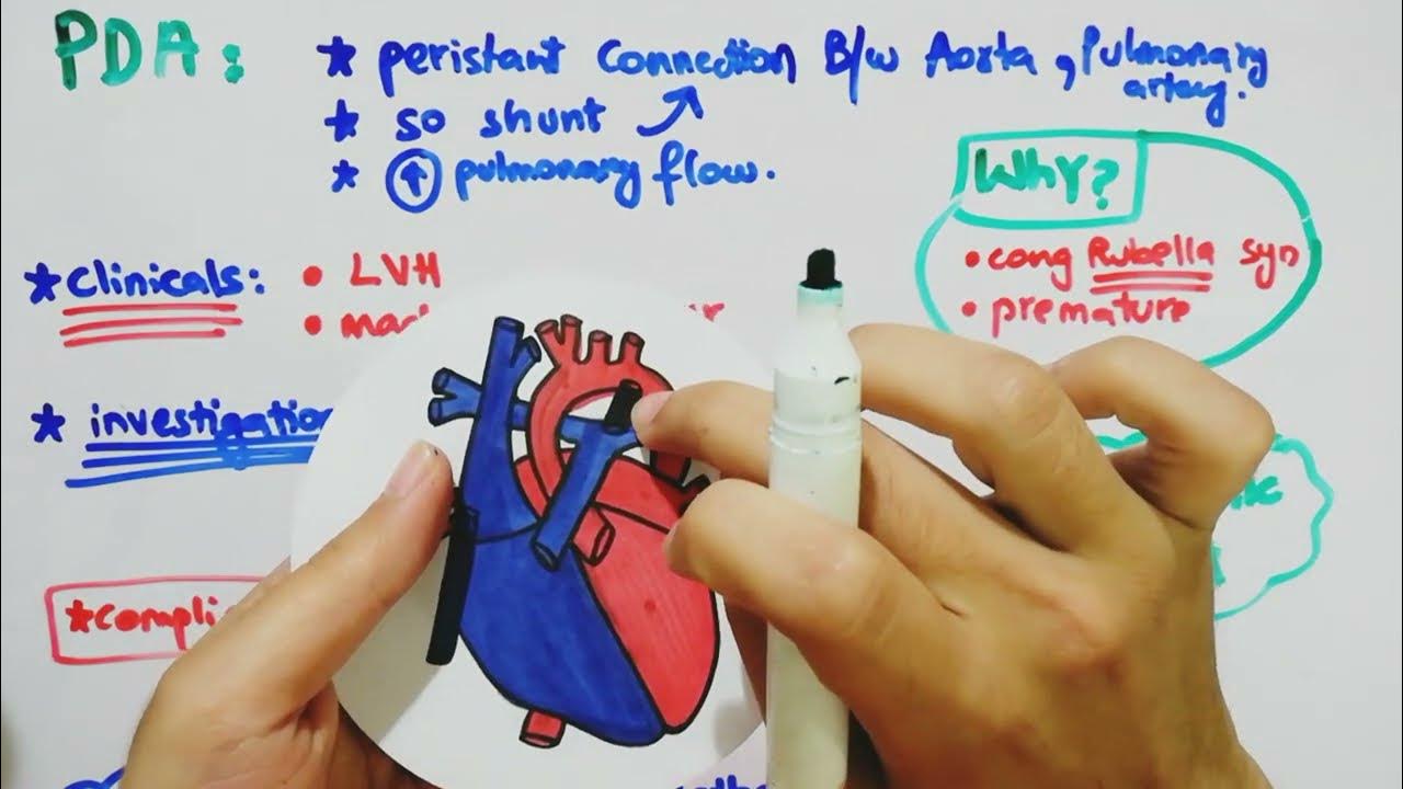 Patent Ductus Arteriosus Pda Case Discussion Dr Deen Lectures