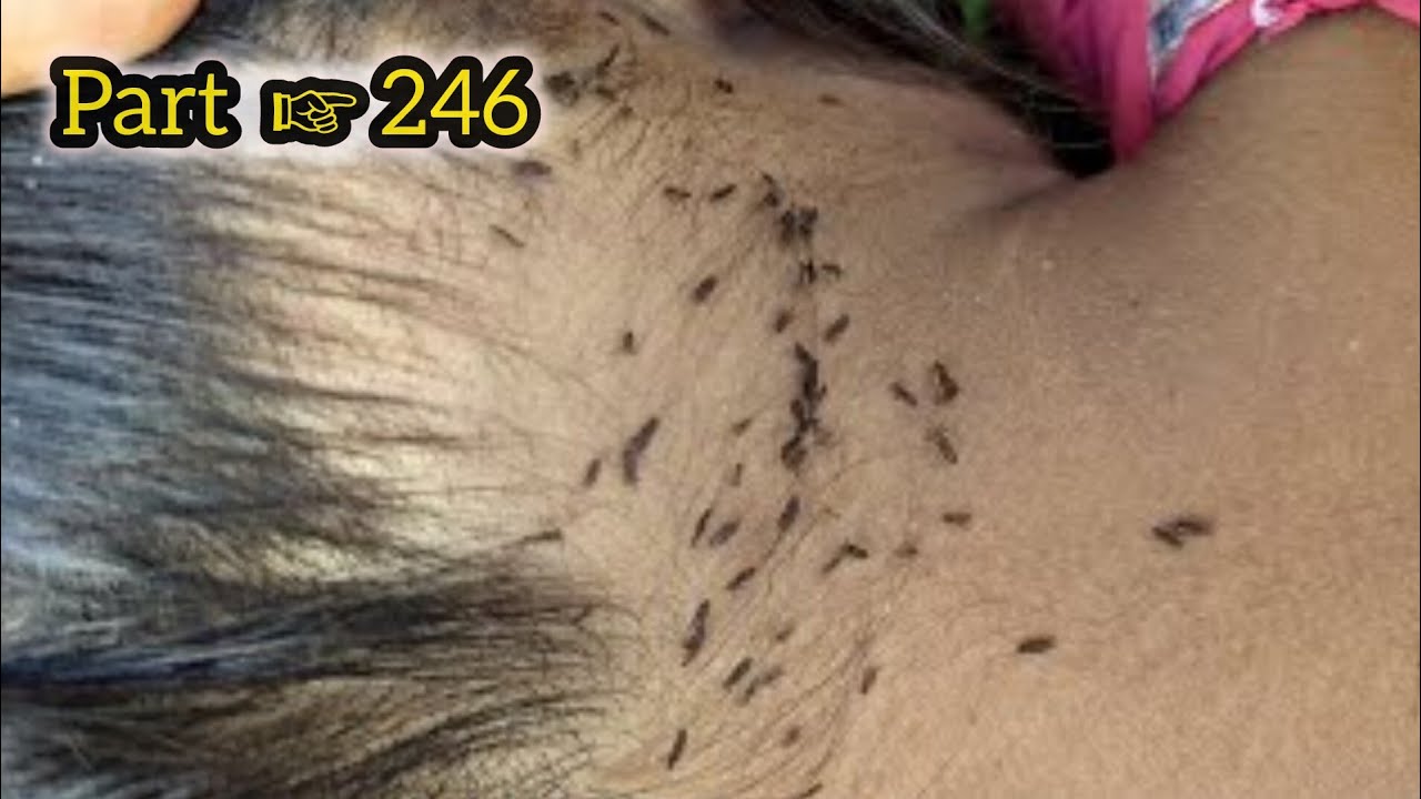 How to picking lice from cute girl hair | How to remove all hundred ...