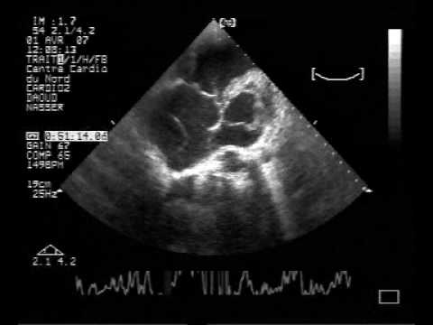 echocardiogram:atrial septal defect with chiari network modified apical ...