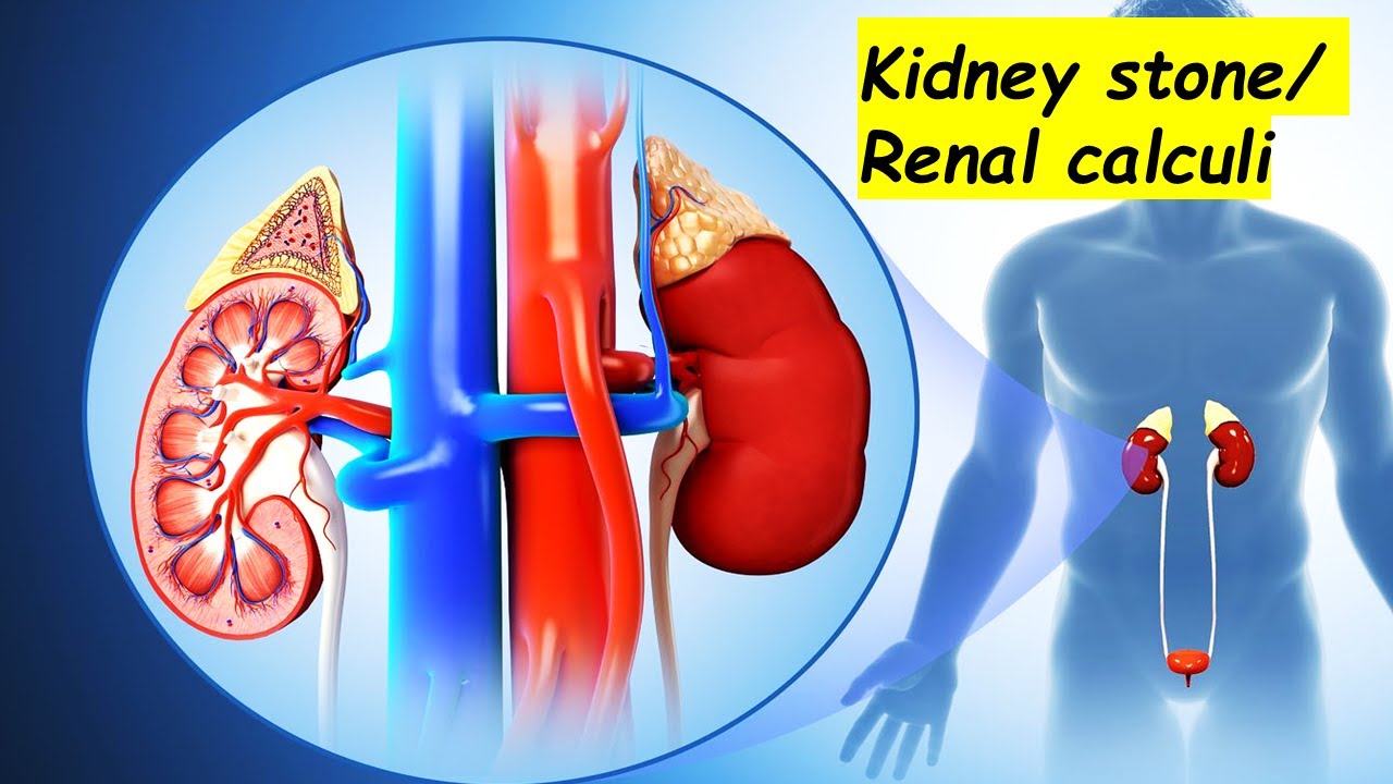 Kidney stones/ Renal calculi - YouTube