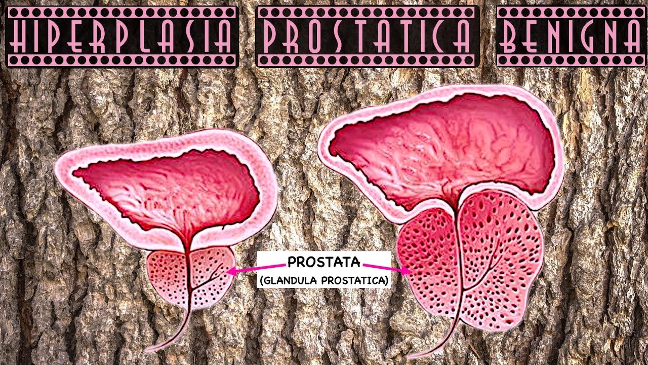 Hiperplasia Prostatica Benigna - YouTube